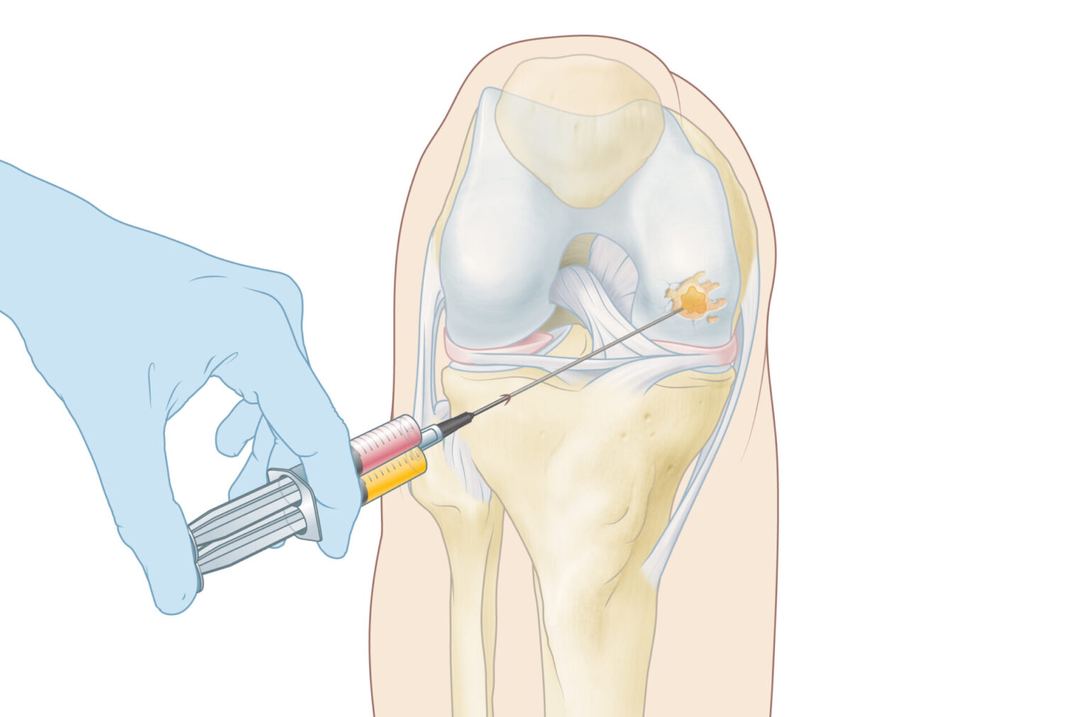 Hy2Care’s Hydrogel: A Game-Changer for Cartilage Repair