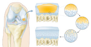 Hy2Care’s Hydrogel: A Game-Changer for Cartilage Repair